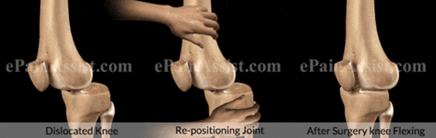 Causes Of Knee Dislocation GIF by ePainAssist - Find & Share on GIPHY